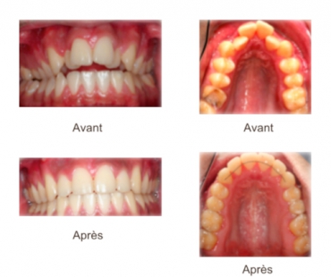 Les causes - Dr Yaël Alcabes Orthodontiste